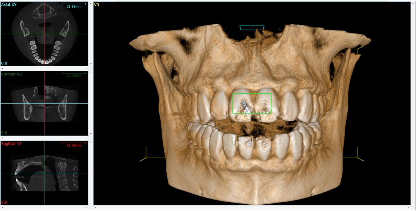 3D Cone Beam & 3D Dental Scans in AZ| Central Valley Dentistry