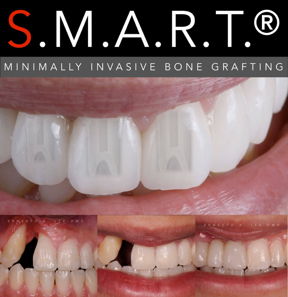 SMART Bone Grafting in Phoenix, Arizona | Central Valley Dentistry