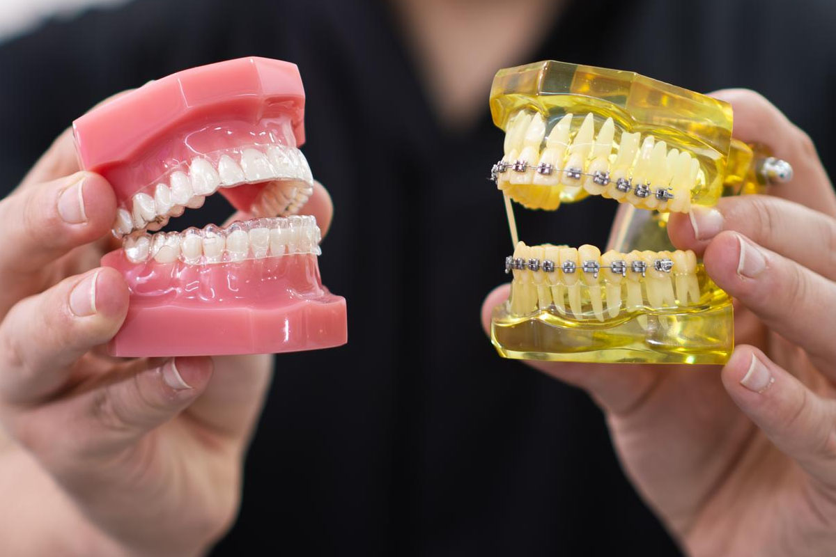 Invisalign Pain vs. Braces, Which is Worse? | Central Valley Dentistry