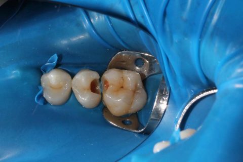 What to Do If You Have a Cracked Filling?