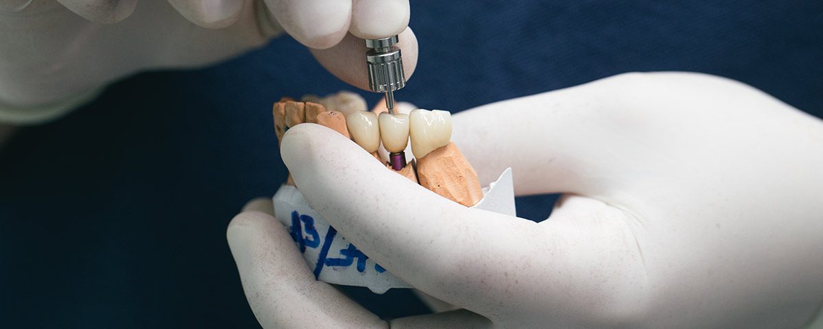 5 Steps of Dental Implant Restoration