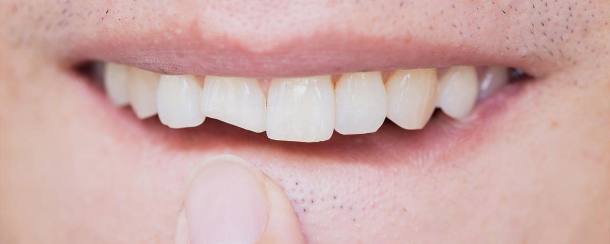 How Long Can a Broken Tooth Go Untreated? | Central Valley Dentistry