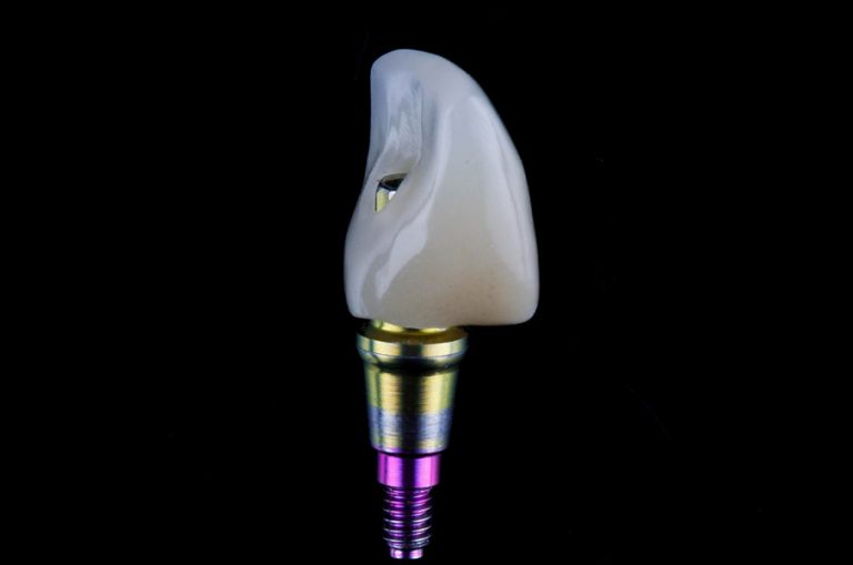 Advanced Dental Implants Peoria | Central Valley Dentistry